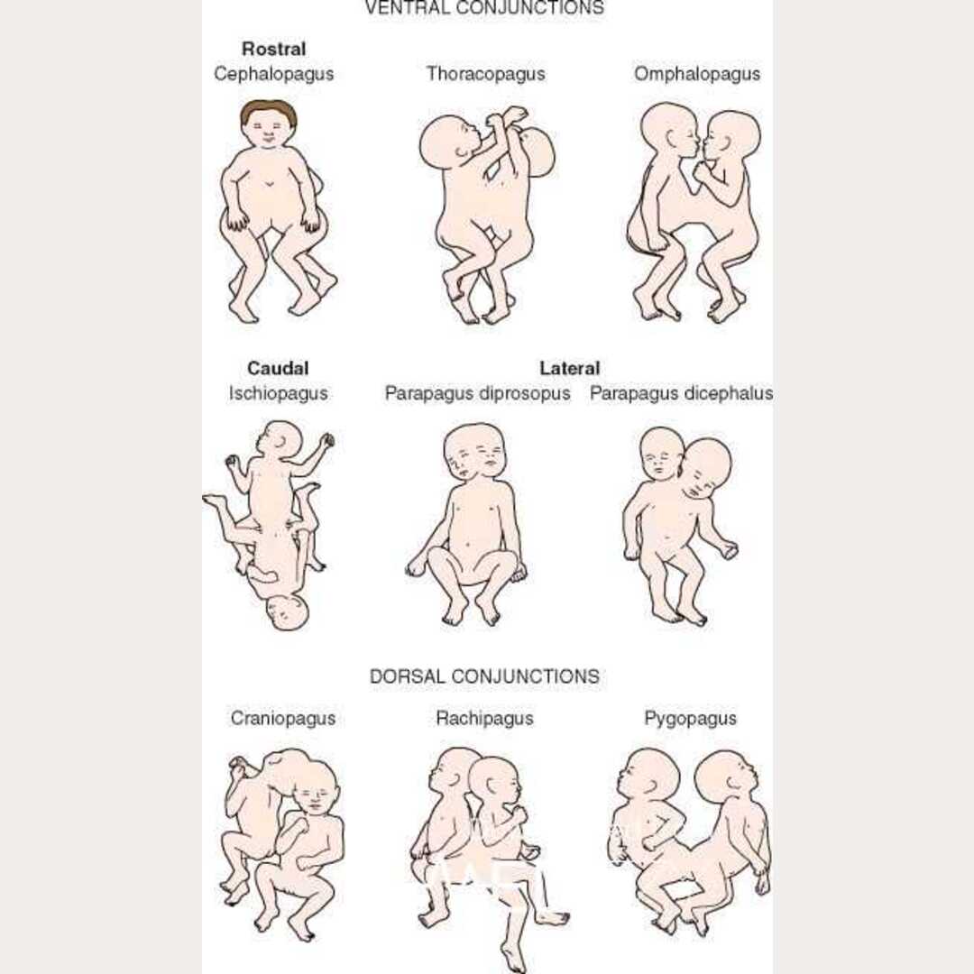 A guide to the main different classifications of Conjoined Twins. Some ...
